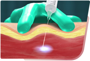 Trigger Point Injection & Muscle Energy Release – Northshore Physical ...